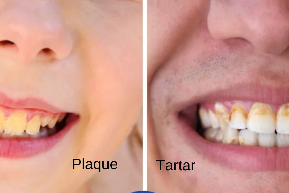 Tips to Remove Plaque and Stop Tartar for a Healthy Smile