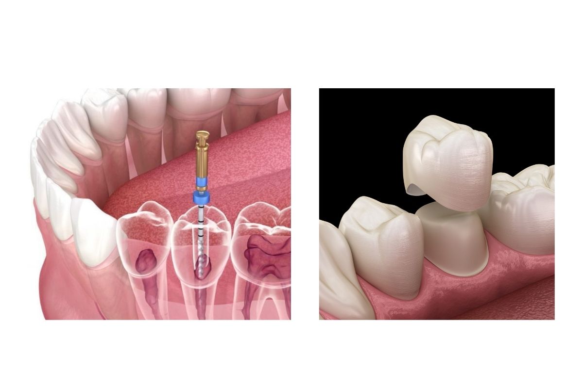 Root Canal vs Crown: Key Differences & When You Need Each